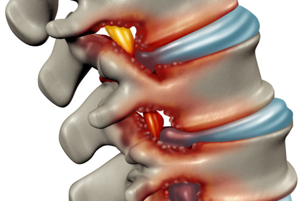 Understanding the Types & Symptoms of Spinal Stenosis | Georgia ...
