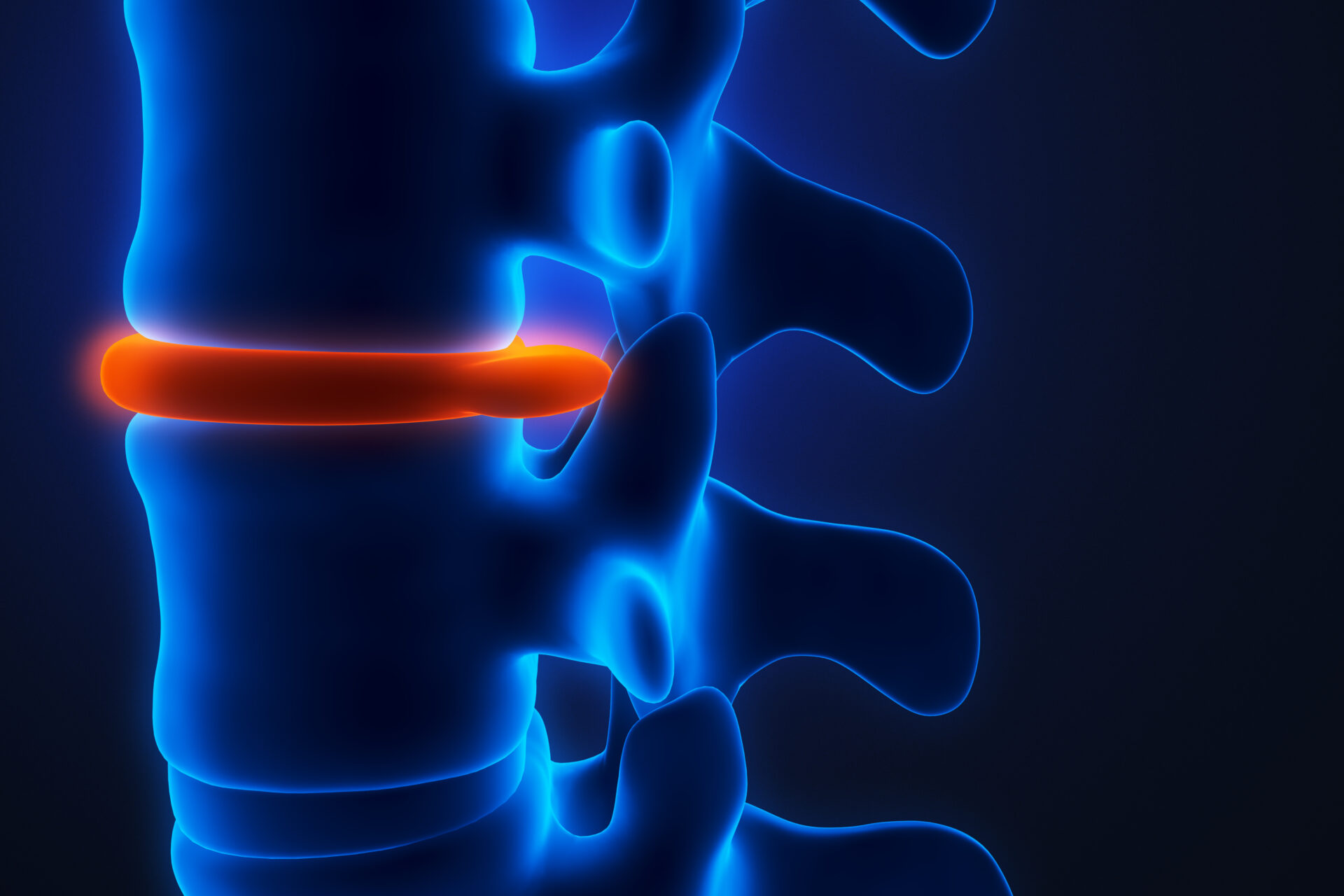Spinal Solutions: Discectomy